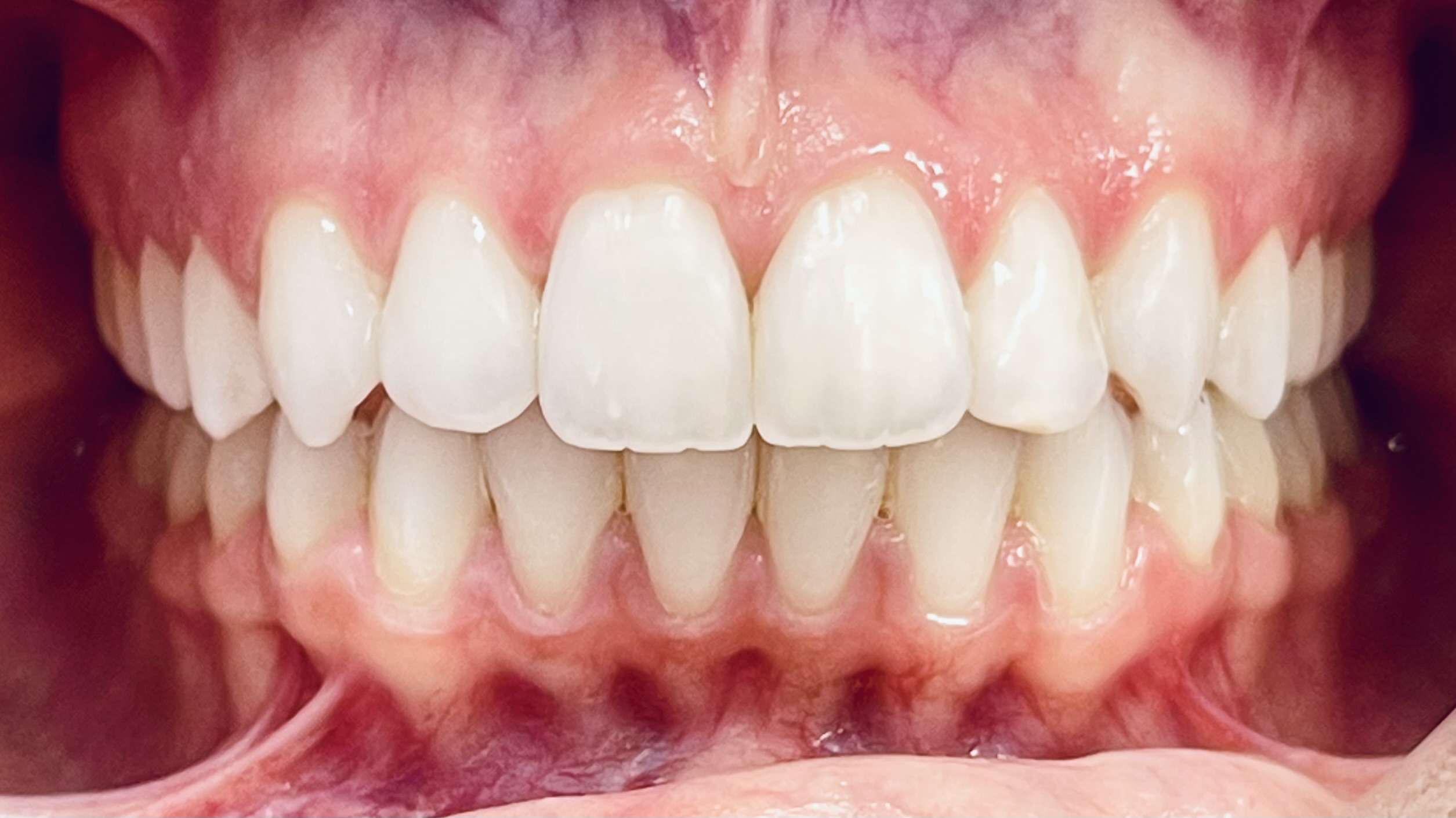 Pediatric Dentist & Orthodontist Miami FL-Braces Invisalign Kendall