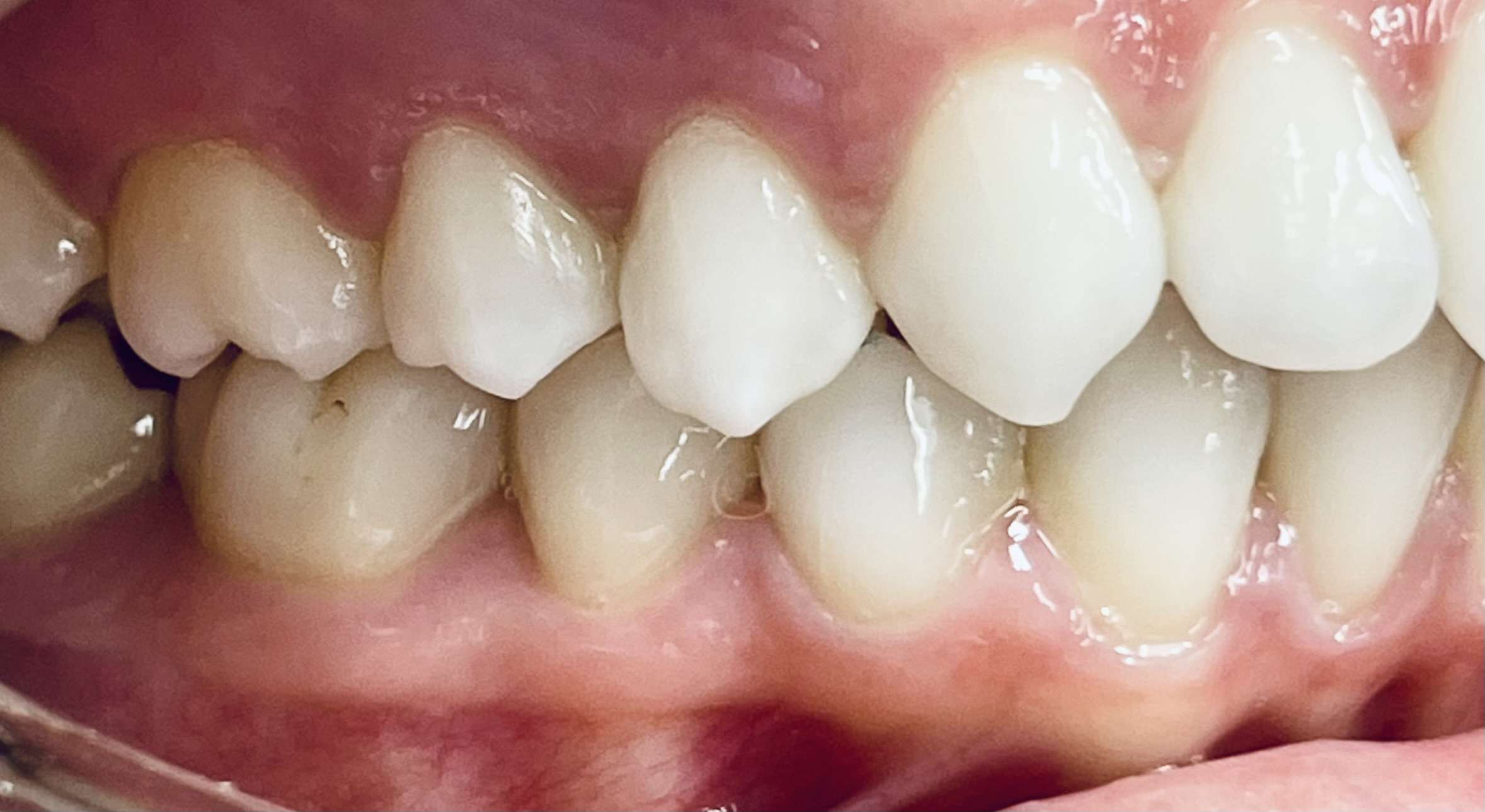 Pediatric Dentist & Orthodontist Miami FL-Braces Invisalign Kendall